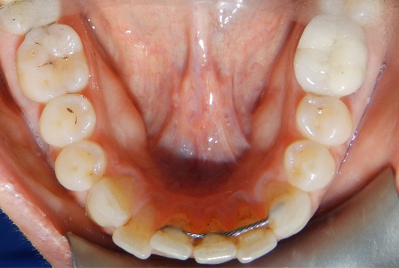 Before and After - N17 Dental | Tottenham